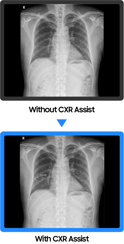 * The CAD results may very per case. * Image Courtesy of Lunit Inc.