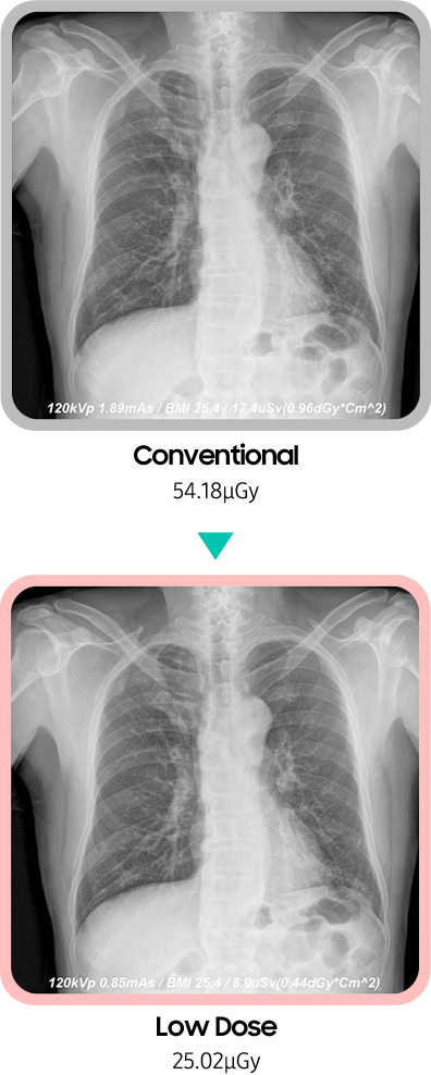 Case 3. Adult Chest PA